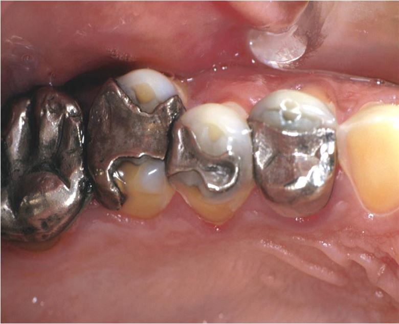 Cavities or Decay - Michael E. Krone, D.D.S. Family Dentistry